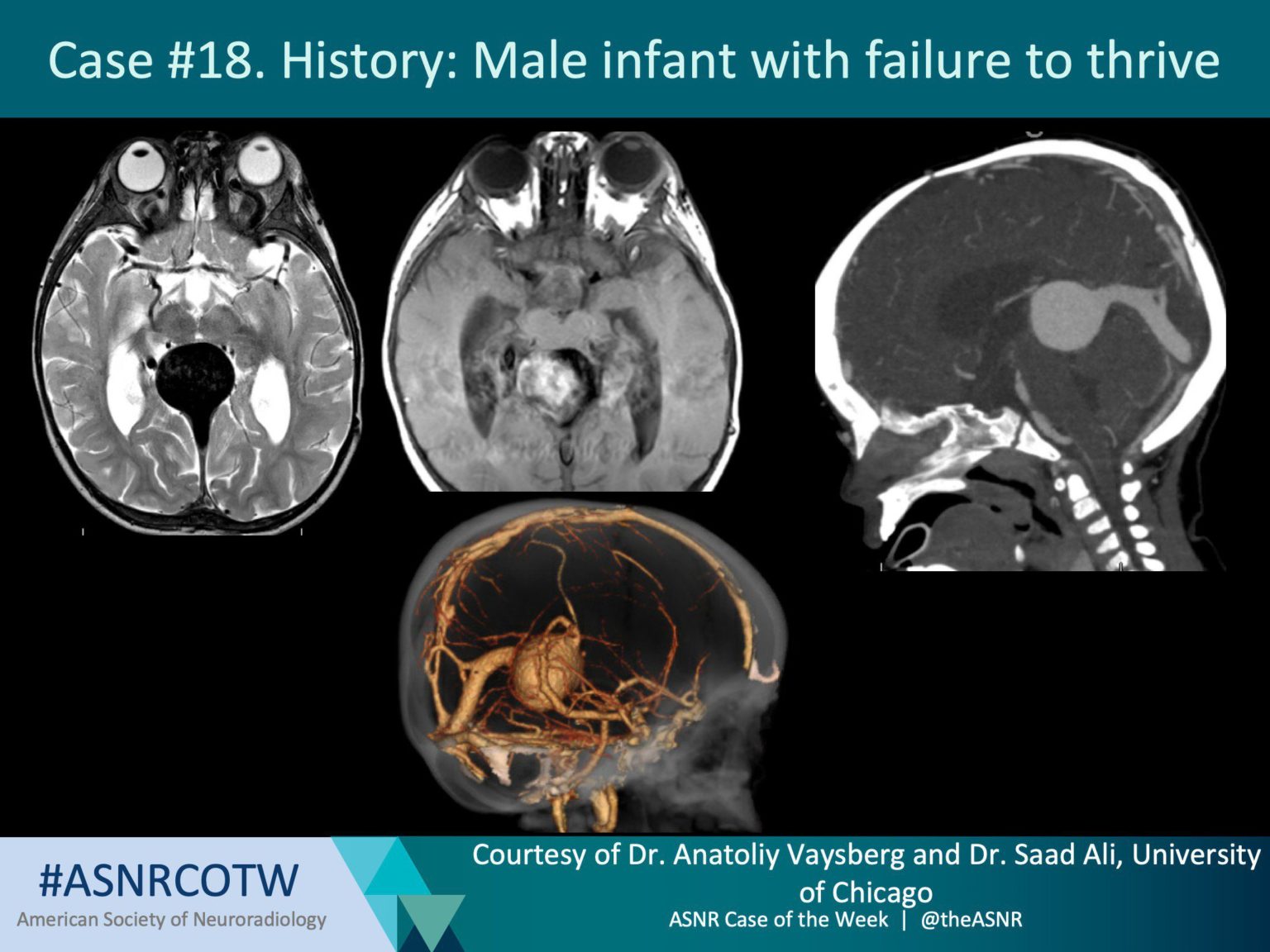 ASNR Case of the Week: Case #18 - American Society of Neuroradiology