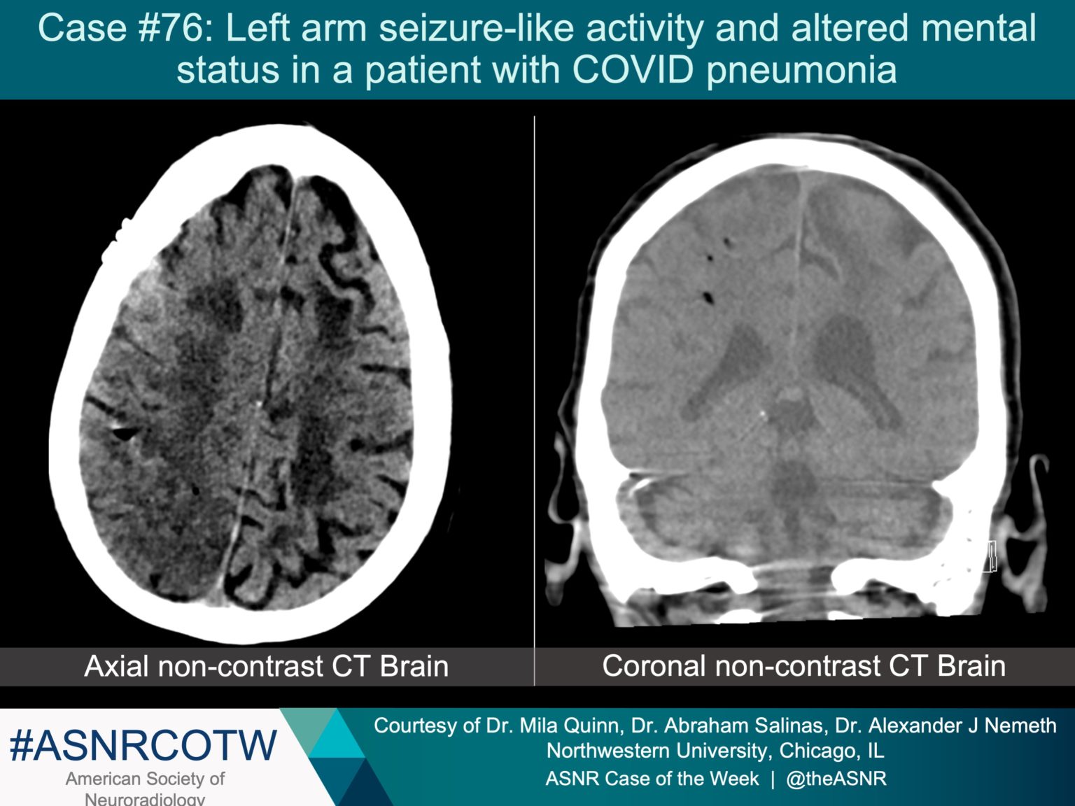 ASNR Case of the Week: Case #76 - American Society of Neuroradiology