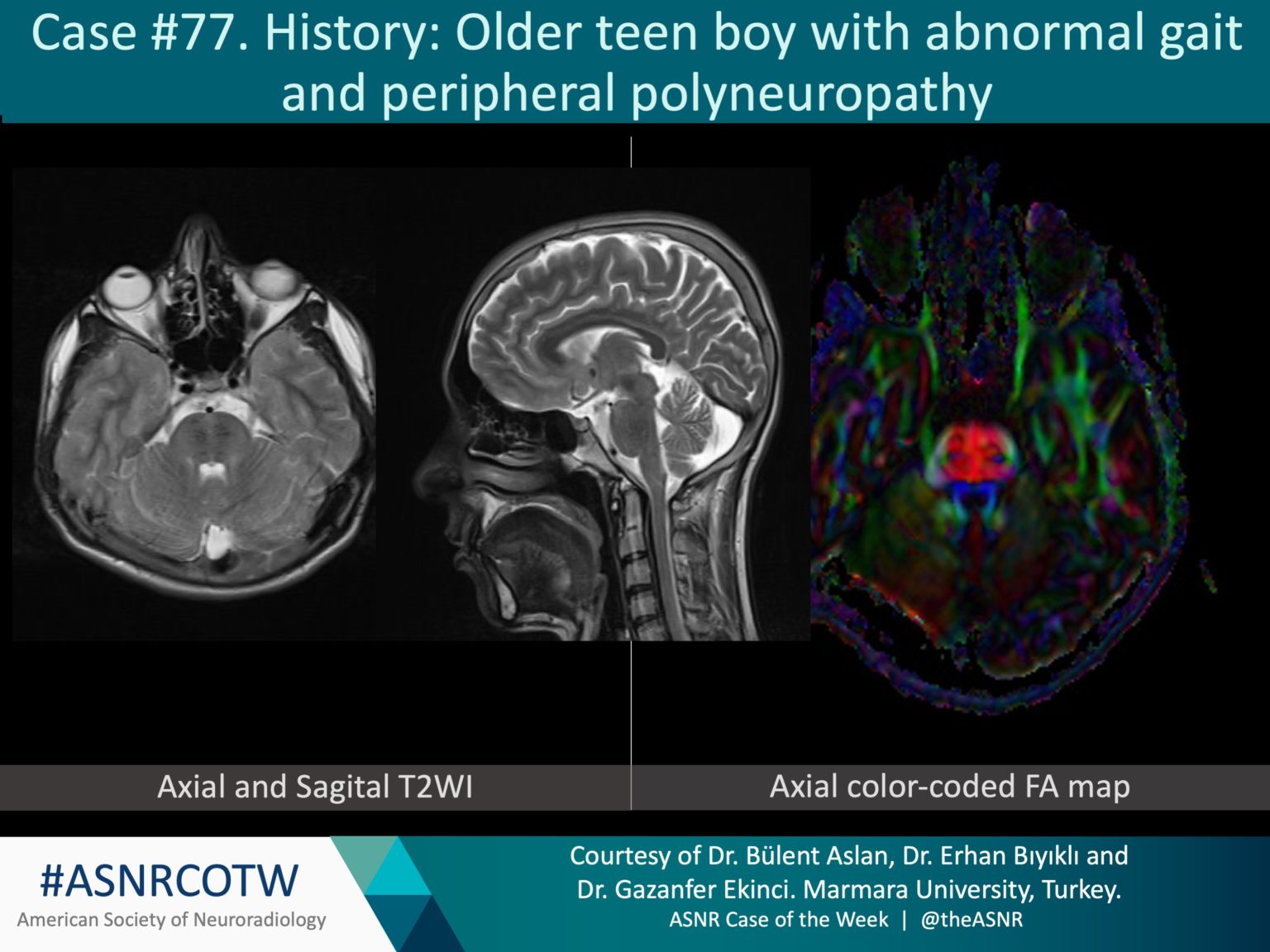 ASNR Case of the Week: Case #77 - American Society of Neuroradiology
