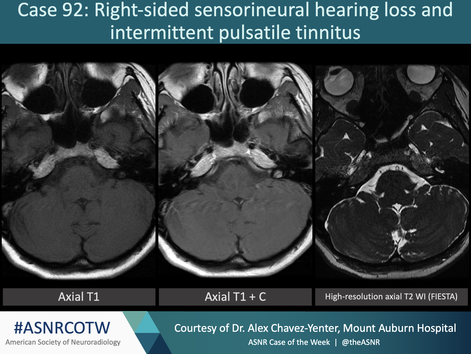 ASNR Case of the Week: Case #92 - American Society of Neuroradiology