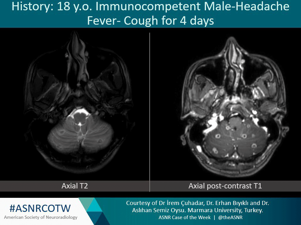 Case of the Week - American Society of Neuroradiology