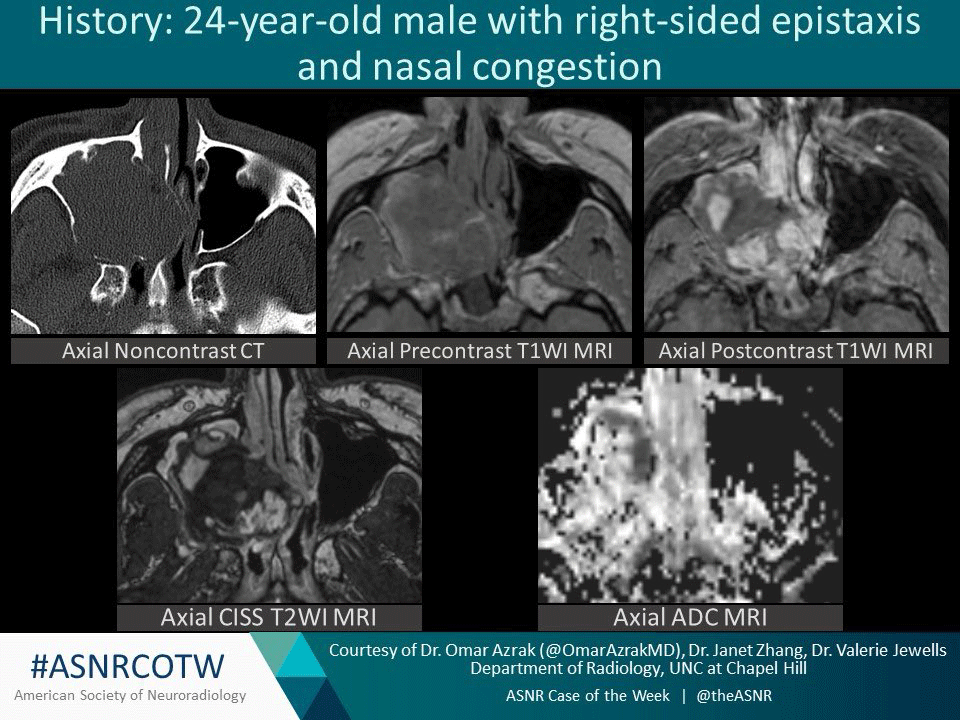 Case of the Week - American Society of Neuroradiology
